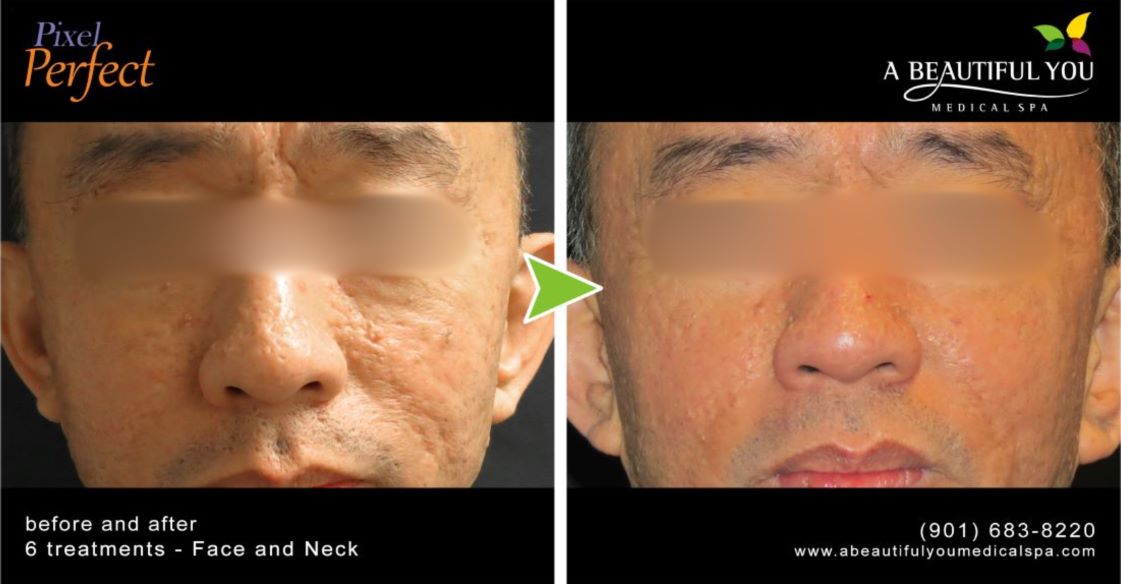 Pixel Resurfacing 1 - A Beautiful You Medical Spa