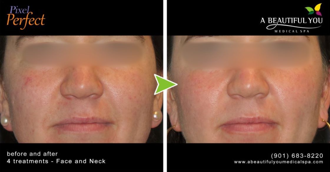 Pixel Resurfacing 6 - A Beautiful You Medical Spa