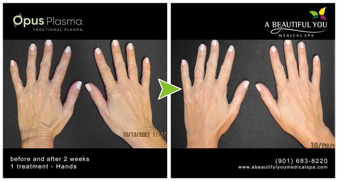 Opus 1 - A Beautiful You Medical Spa