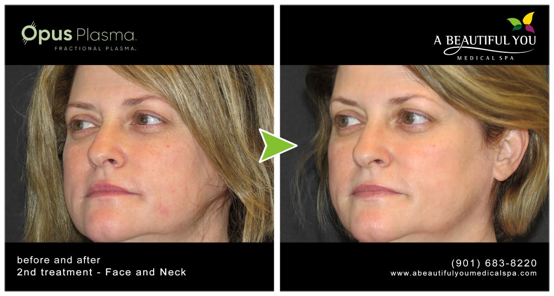 Opus 6 - A Beautiful You Medical Spa