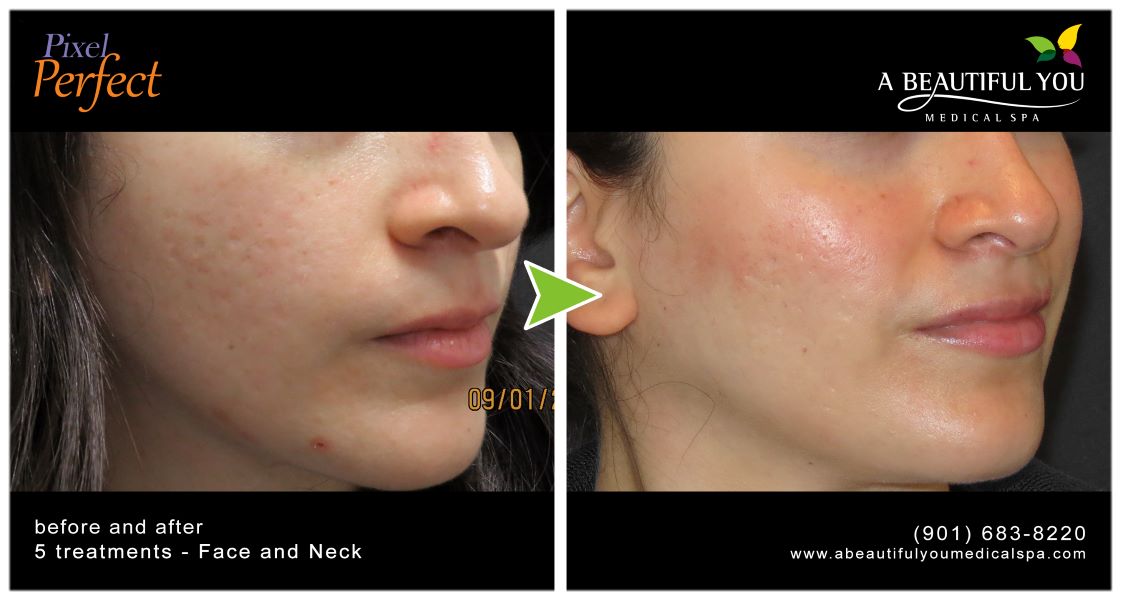 Pixel Resurfacing 3 - A Beautiful You Medical Spa